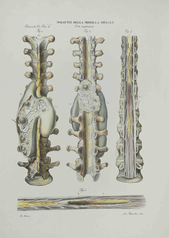Ottavio Muzzi, Diseases of the Spinal Cord, Lithograph, 1843 for sale ...