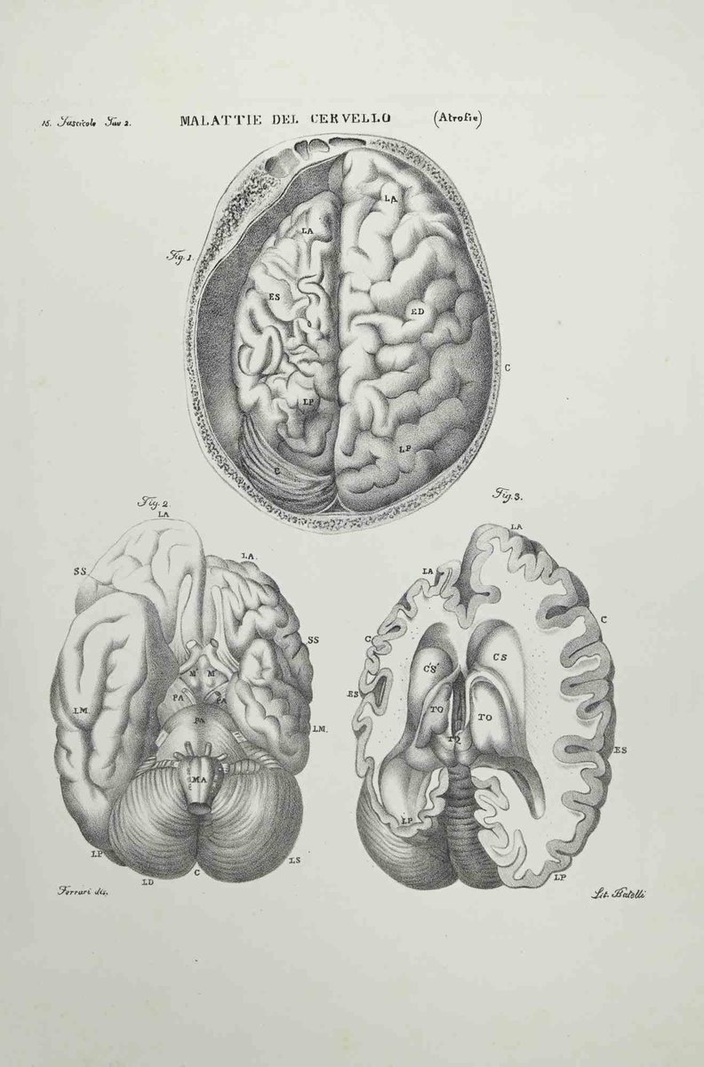 Ottavio Muzzi, Brain Diseases, Lithograph, 1843 for sale at Pamono