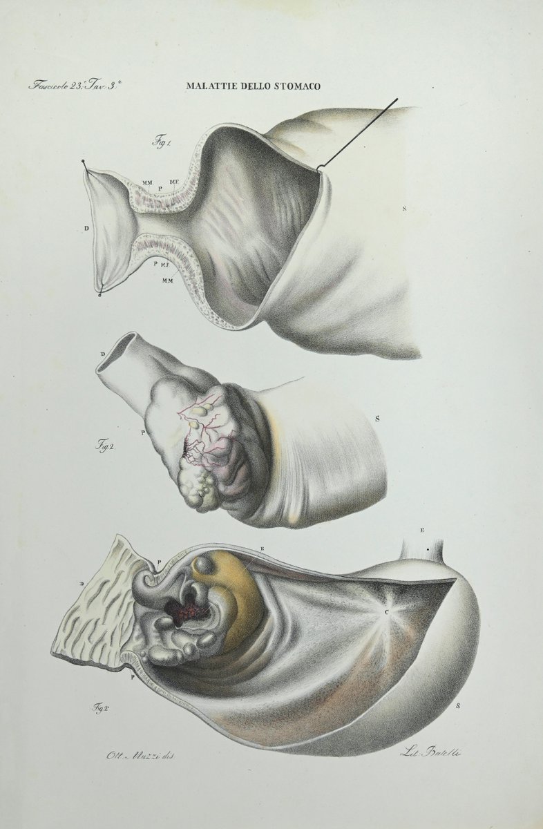 Ottavio Muzzi, Stomach Diseases, Lithograph, 1843 for sale at Pamono